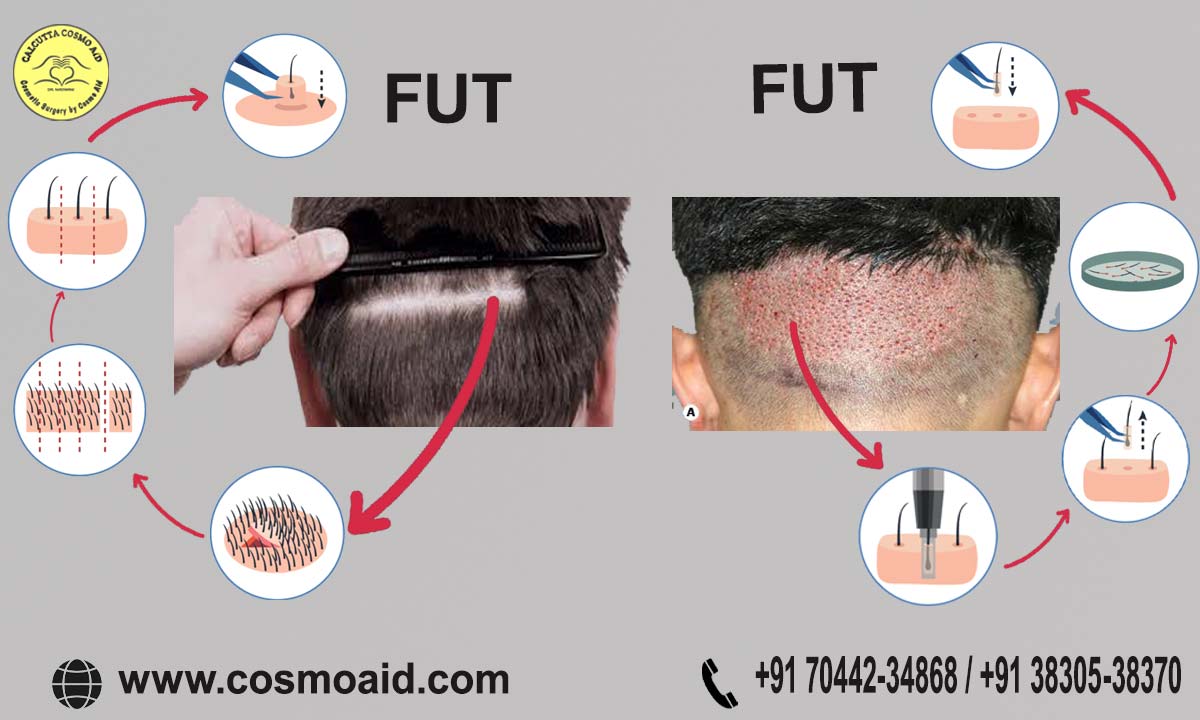 FUT Vs FUE: Unveiling The Best Hair Transplant For You-cosmoaid