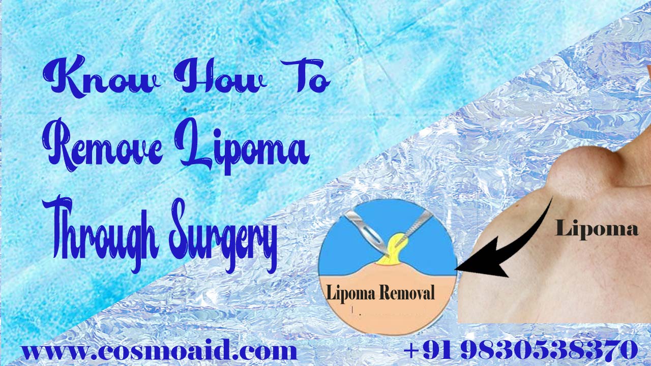 Know about Lipomas Surgical Removal Complete Guide