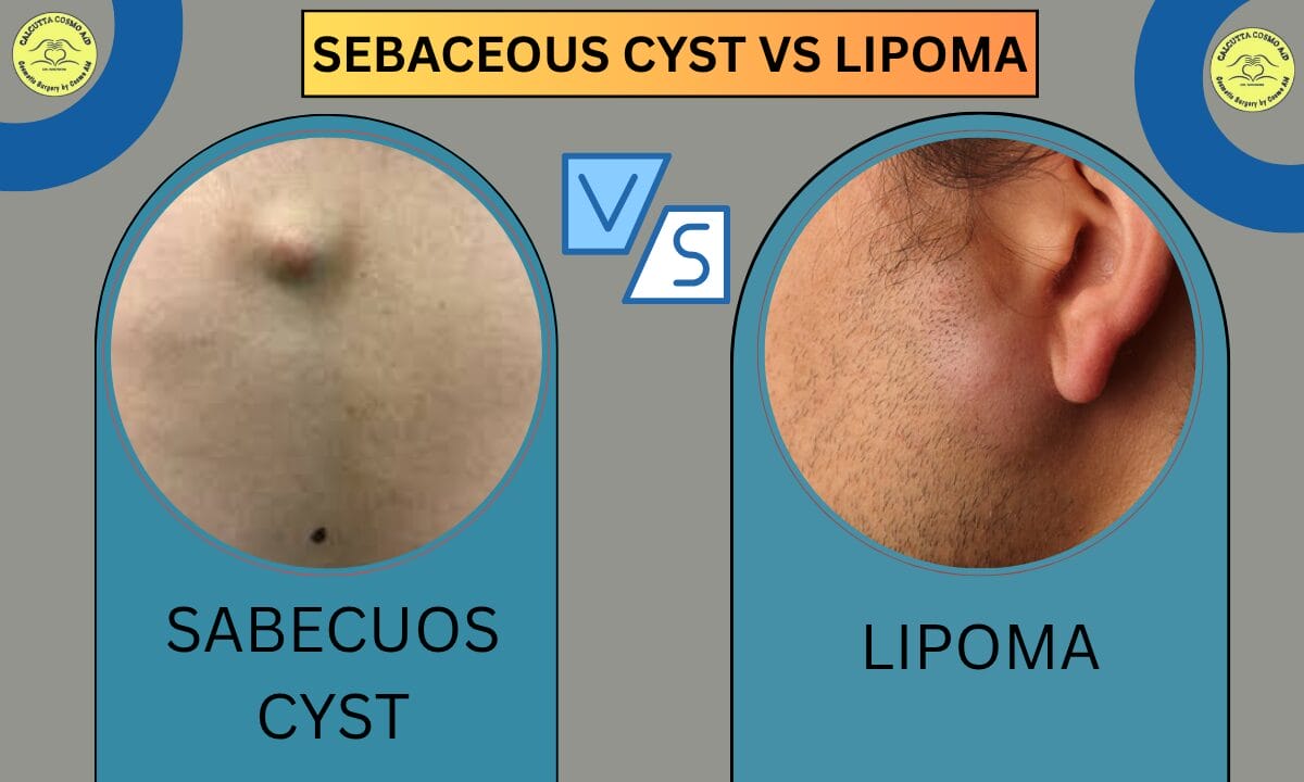 Sebaceous Cyst vs Lipoma